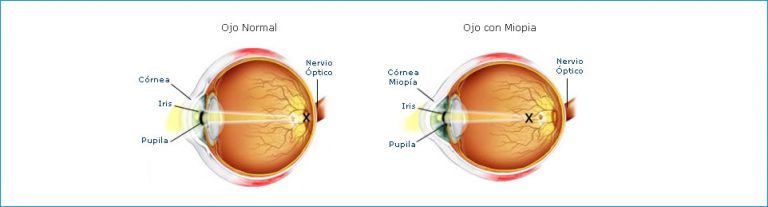 Defectos Visuales Optica Mecavision